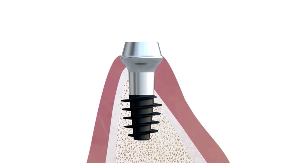MagiCore Implants | IBS Europe