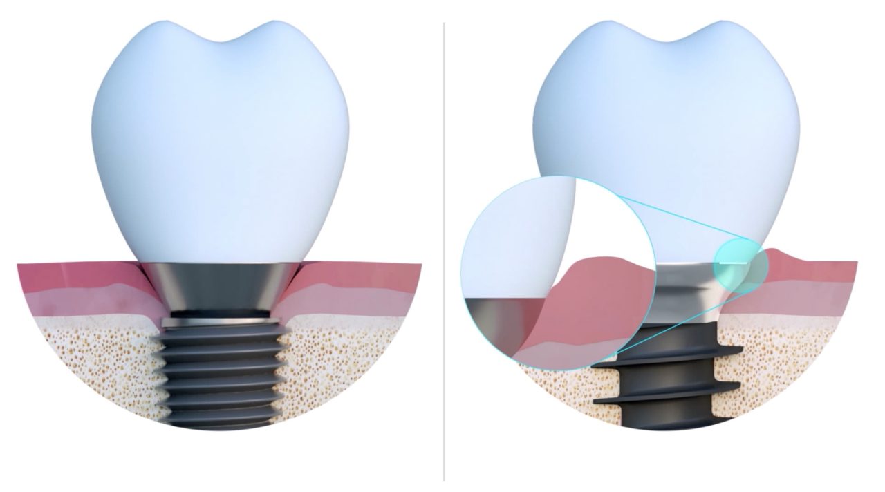 MagiCore Implants | IBS Europe