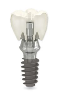 MagiCore Implants | IBS Europe